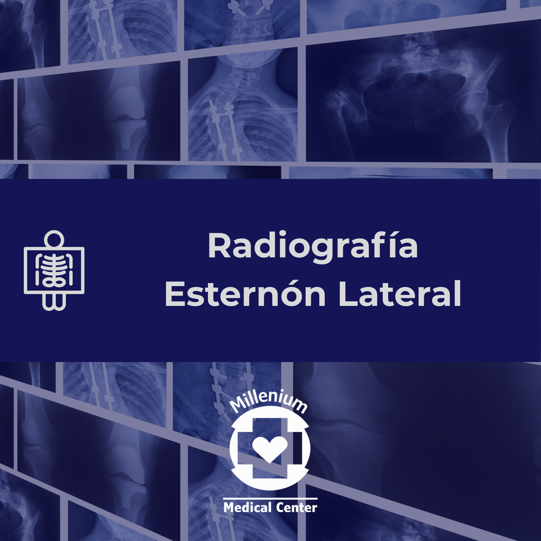 ESTERNON LATERAL | Hospital Millenium